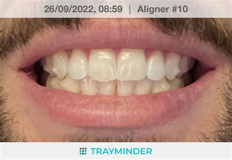 Ortho Says My Last Two Invisalign Trays Are My Final Retainer Anyone Else Get Told The Same