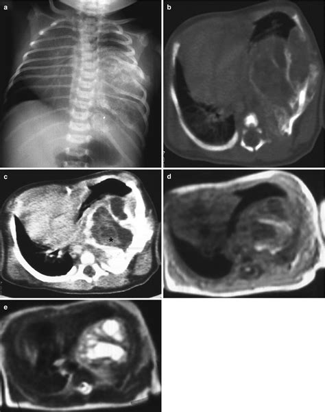 Tumors Of The Pediatric Chest Radiology Key