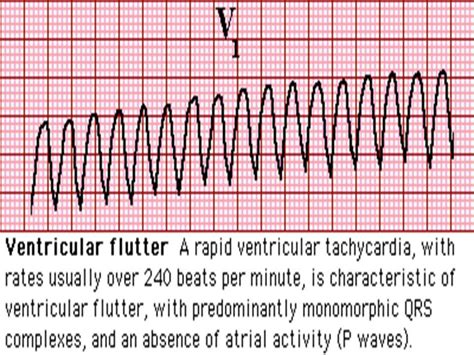 Ventricular Flutter Vs Fibrillation