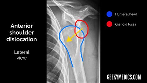 X Ray Shoulder Dislocation