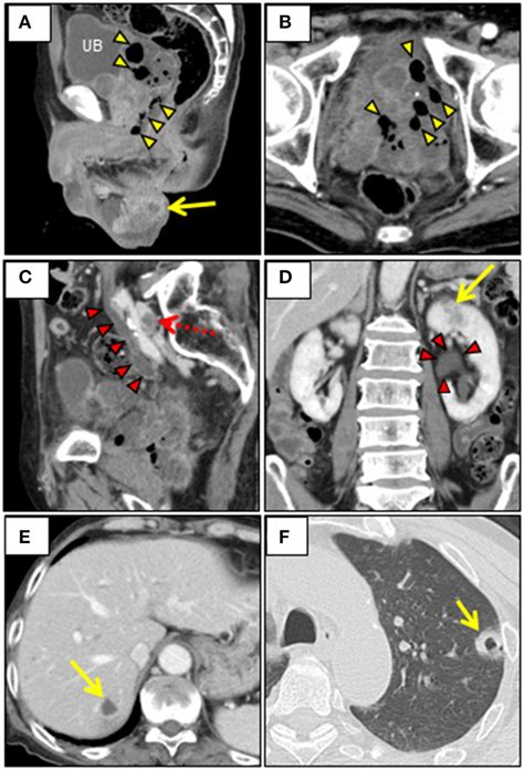 Contrast Enhanced Whole Body Ct A B Pelvic Ct Reveals The
