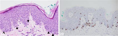 Hypopigmented Macules On The Suprapubis And Axillae Jaad Case Reports