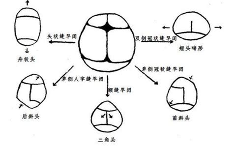 额缝早闭 颅缝早闭 宝宝颅缝早闭图片 大山谷图库