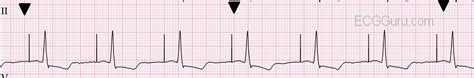Atrial Pacing Ecg Guru Instructor Resources