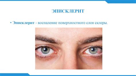 Заболевания сосудистого тракта хрусталика стекловидного тела роговицы и склеры презентация