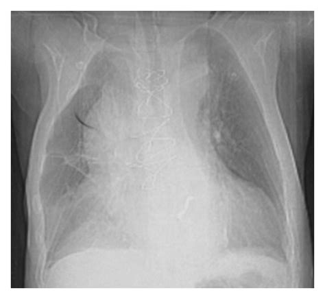 Chest X Ray Revealed Enlargement Of Mediastinum Download Scientific
