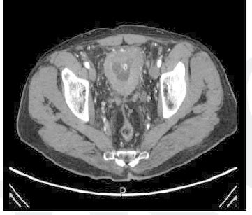 Pelvic Computed Tomography Showing The Multiple Enlarged Lymph Nodes Download Scientific Diagram