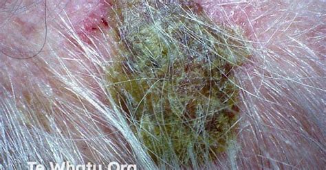 Erosive Pustular Dermatosis Of The Scalp Image