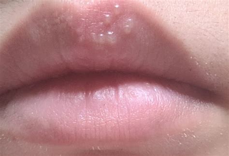 입술 물집 지식in