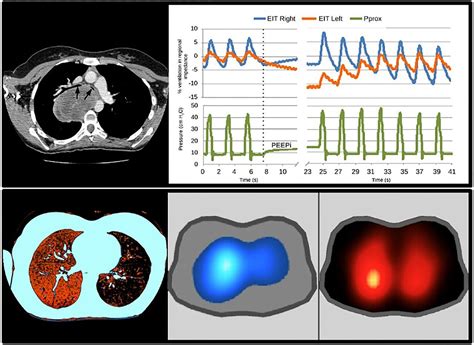 Electrical Impedance Tomography Guardian Ideas