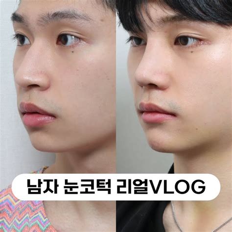 남자 눈코턱 성형수술 리얼 Vlog Youtube