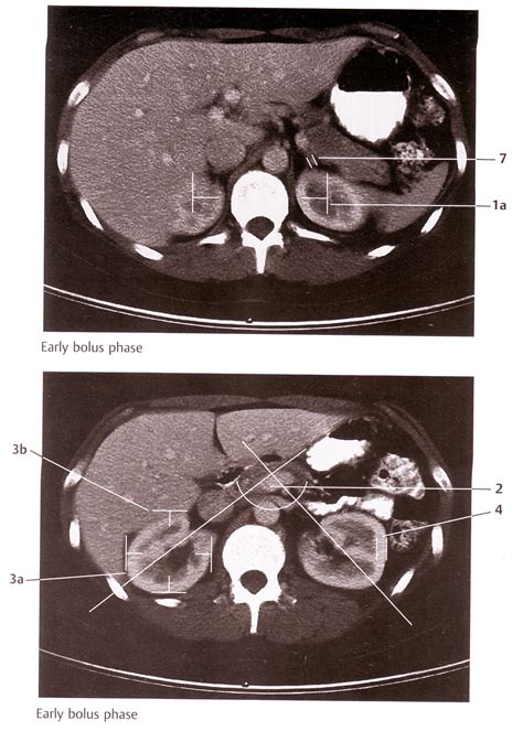 ЭЭТНХ Бөөр Хоёр бөөрний хэмжээ байрлал паренхимийн