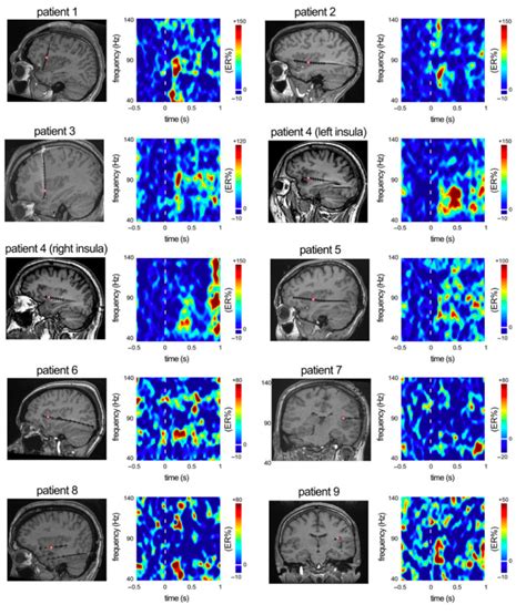 Intracerebral Eeg