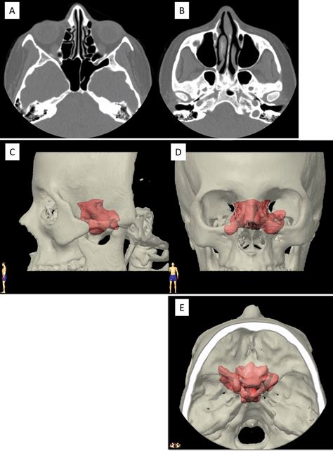 Sphenoid Sinus Anatomy