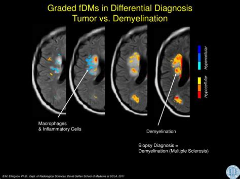 ppt functional diffusion maps fdms for brain tumor treatment response monitoring powerpoint