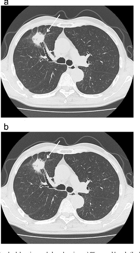 Figure 1 From Standard Dose Vs Low Dose Ct Protocols In The Evaluation Of Localized Lung