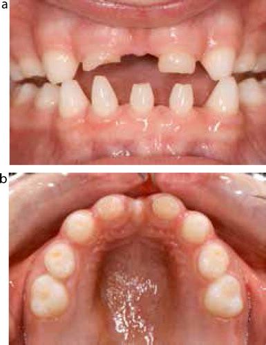 Ectodermal Dysplasia Teeth