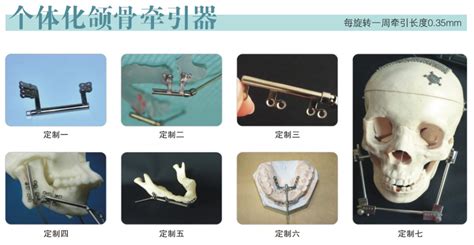 定制牵引器颌骨牵引器中邦牌钛制牵引器西安中邦钛生物材料有限公司