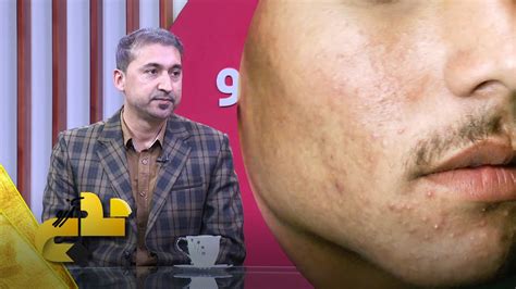 جوانی دانه چیست و چرا پیدا میشود؟ Youtube