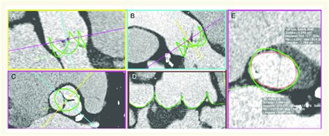 Mdct 3d Anatomic Annulus Represented In Three Orthogonal Planes Download Scientific Diagram