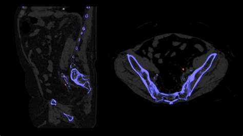 Dual Energy Ct Spectral Imaging Siemens Healthineers Usa