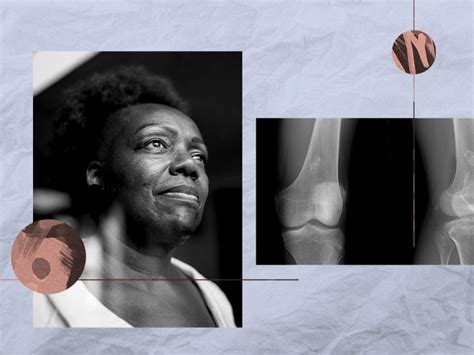 Ewing Sarcoma Survival Rate Age Groups And More