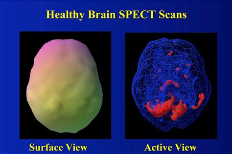 Brain Scans By Daniel Amen Watchvmlkj1puowcg