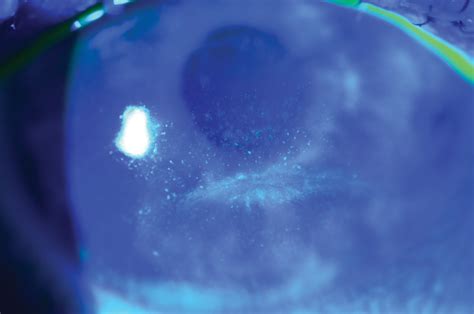 Corneal Ulcer Fluorescein