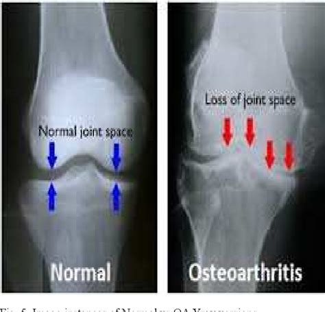 Figure 1 From A Comprehensive Review Analysis On Osteoarthritis Using