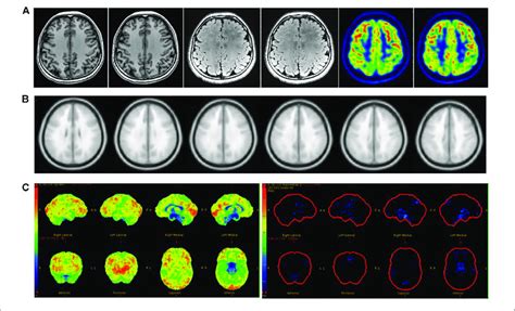 Female 21 Years Old Right Frontal Lobe Epilepsy A No Structural Download Scientific