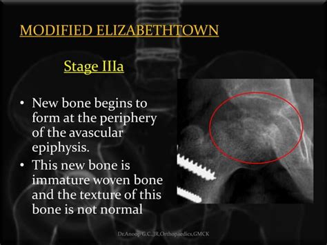 Classification Perthes Disease Pdf