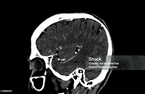 Ct Scan Bidang Sagital Otak Untuk Diagnosis Tumor Otak Penyakit Stroke Dan Penyakit Pembuluh