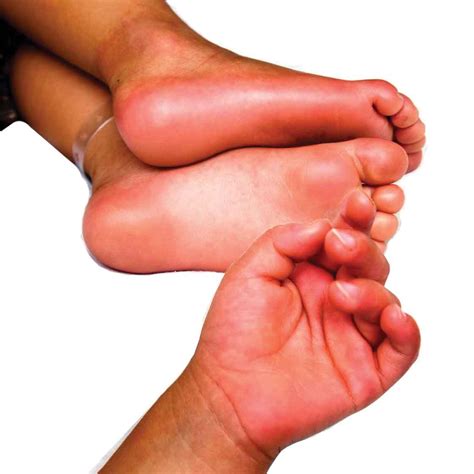 What Causes Red Spots On Palms Of Hands And Soles Of Feet