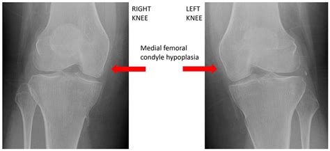 Structural Bone Abnormality In The Knees Of A Patient With The Stickler Download Scientific