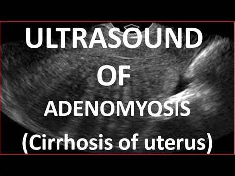 Adenomyosis Ultrasound