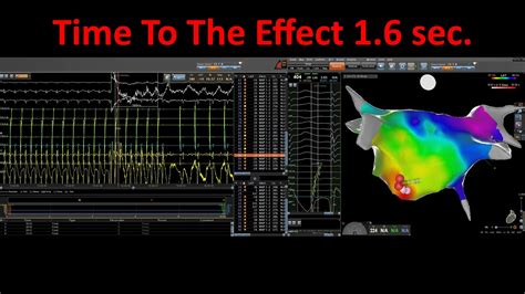 Focal Iterative Atrial Tachycardia Ablation Youtube