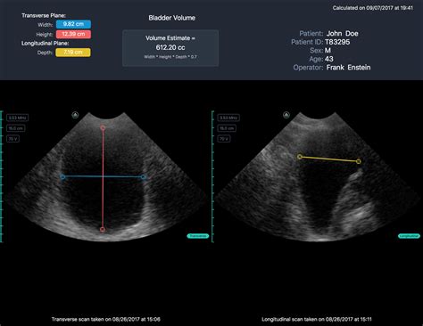 formula to calculate bladder volume ultrasound bladder volume swhshish