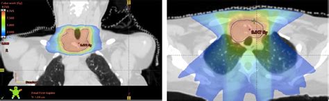 Figure 1 From Refractory Riedels Thyroiditis Managed With Low Dose