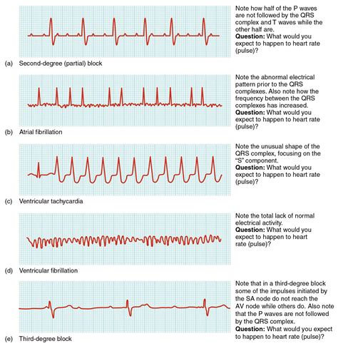 Common Ecg Abnormalities Diagram A Detailed Guide Anatomy Note