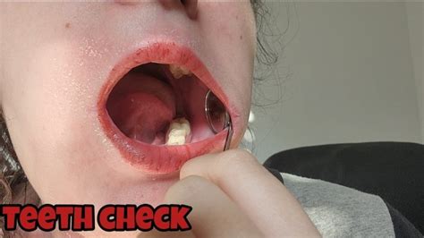 Dental Mirror And Hook Teeth Inspection Fetish Exploring My Mouth And Showing Every Tooth In