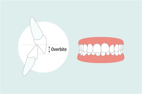 Underbite Vs Overbite Whats The Difference And How Are They Treated Hawley Orthodontics