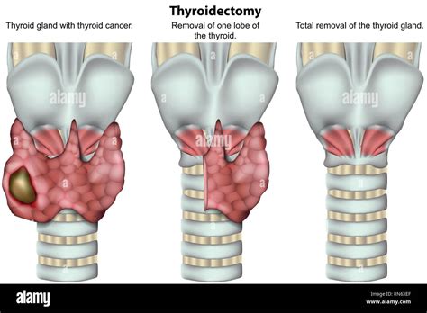 Thyroidectomy By Nursingcrib