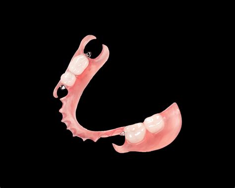Unilateral Removable Partial Denture