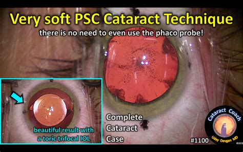 1100 Very Soft Psc Cataract Technique Cataract Coach™