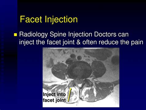 Ppt Facet Injection Powerpoint Presentation Free Download Id1828756