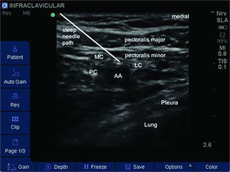 Ultrasound Guided Infraclavicular Brachial Plexus Block Hadzics My Xxx Hot Girl