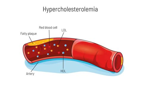Genetic Prevention For Hypercholesterolemia