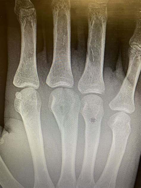 Boxers Fracture Of The 3rd Metacarpal R Radiology