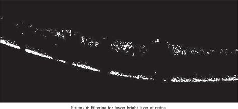 Figure 6 From Automatic Detection Of Hard Exudates Shadow Region Within Retinal Layers Of Oct