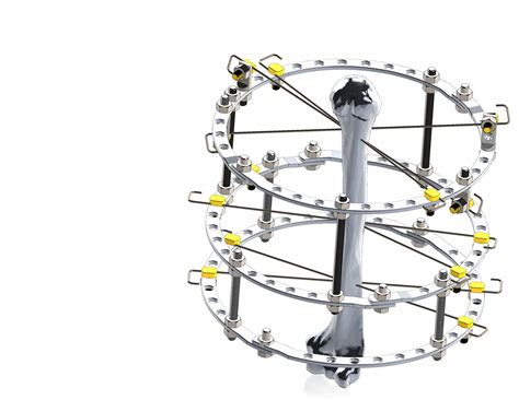 这种类型的框架用于治疗骨骼，它被称为“伊利扎洛夫技术”。该技术用于矫正先天性畸形骨、骨折和骨延长 Solidworks 模型图纸下载 懒石网